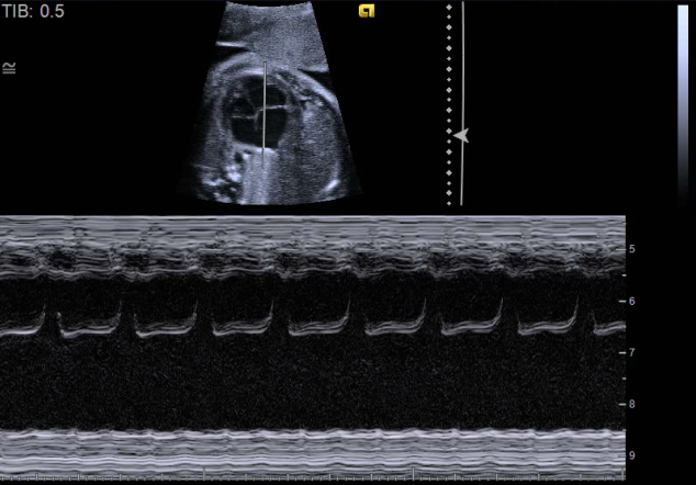 Atrial Flutter | Pediatric Echocardiography