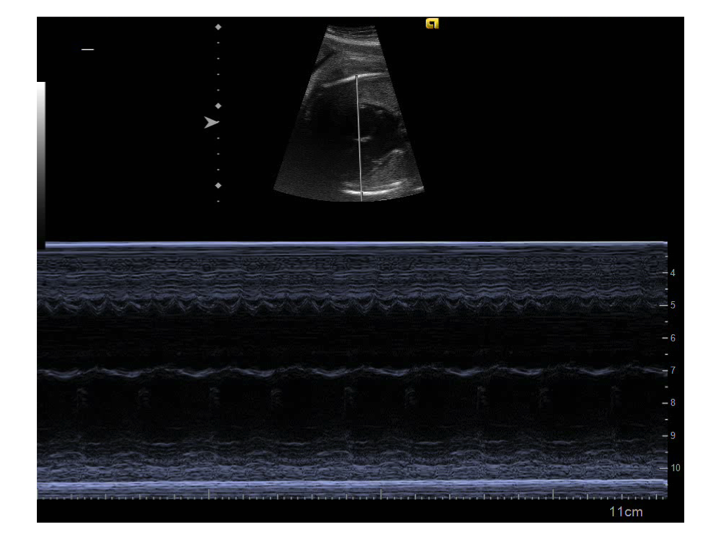 Atrial Flutter | Pediatric Echocardiography