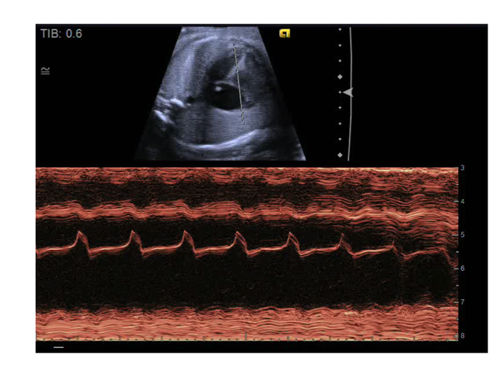 Atrial Flutter | Pediatric Echocardiography