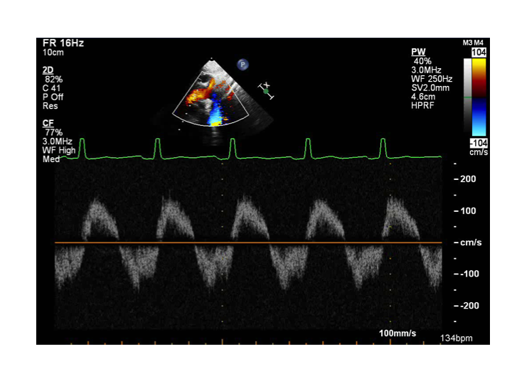 Suprasternal notch | Pediatric Echocardiography