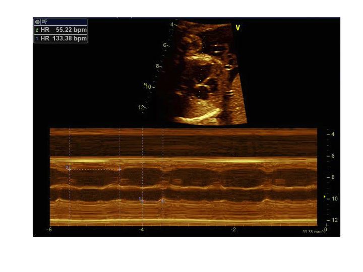 Congenital Heart Block | Pediatric Echocardiography