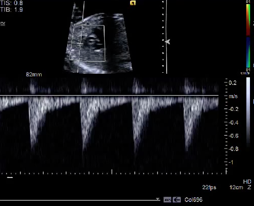 Aortic Arch | Pediatric Echocardiography