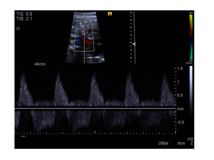 Aortic Arch | Pediatric Echocardiography