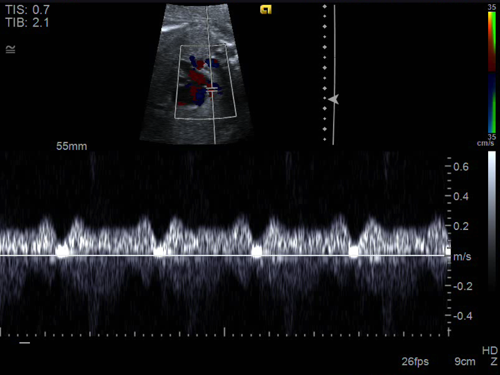 Fetal Echo Clips: Apical 4 Chamber | Pediatric Echocardiography