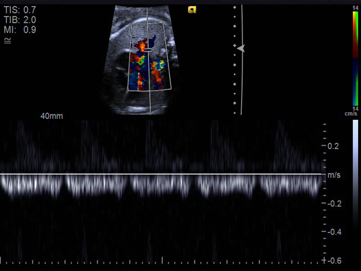 Fetal Echo Clips: Apical 4 Chamber | Pediatric Echocardiography