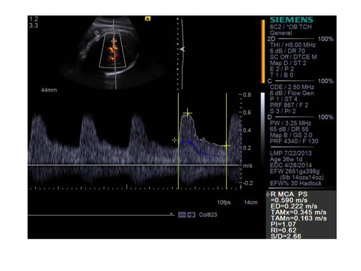 Fetal HLHS | Pediatric Echocardiography