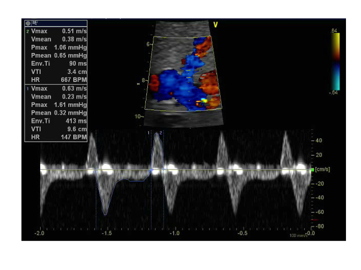 Atrial Septum | Pediatric Echocardiography