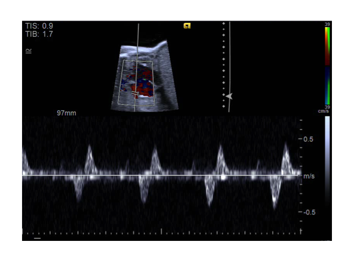 Atrial Septum | Pediatric Echocardiography
