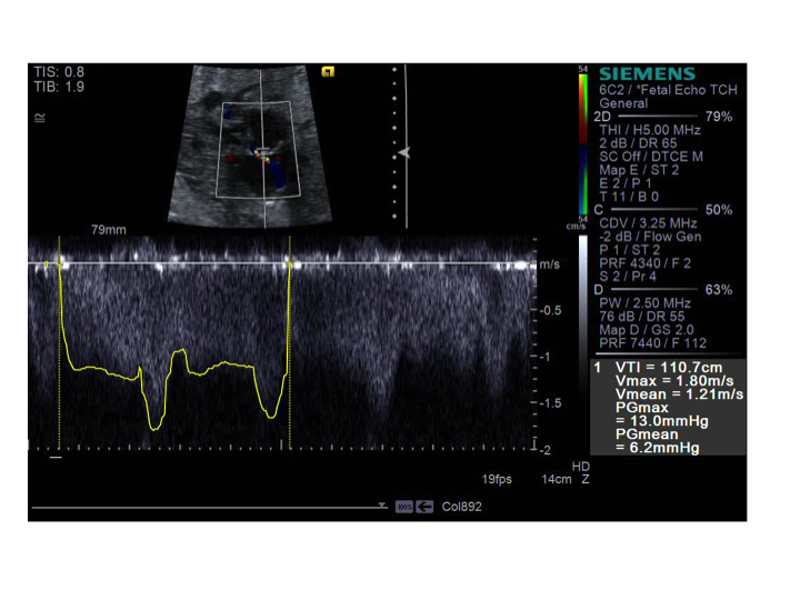 Atrial Septum | Pediatric Echocardiography