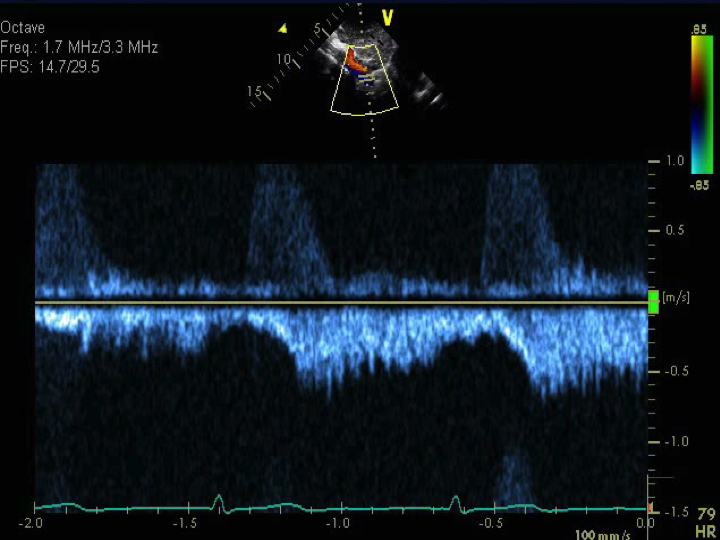 Subcostal Abdominal Aorta | Pediatric Echocardiography