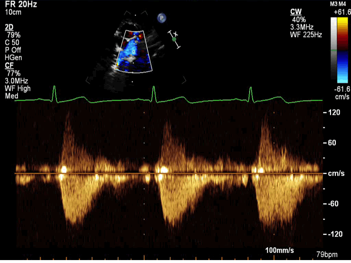 High parasternal short axis focused on branch pulmonary arteries ...