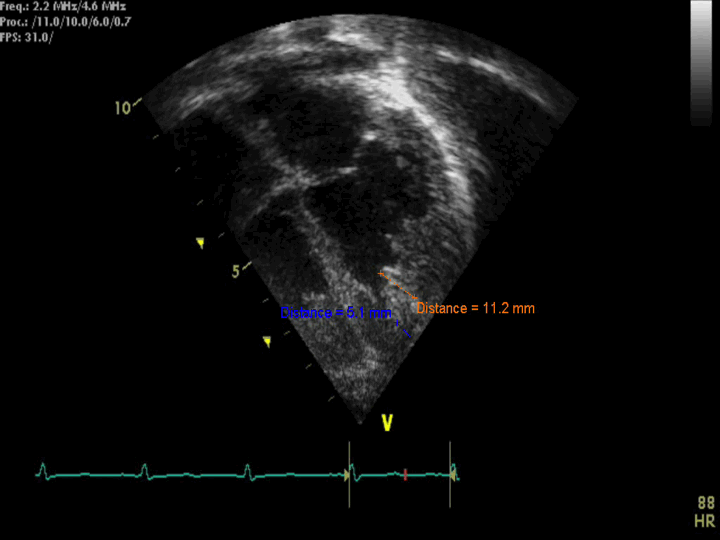 Apical 4 chamber | Pediatric Echocardiography