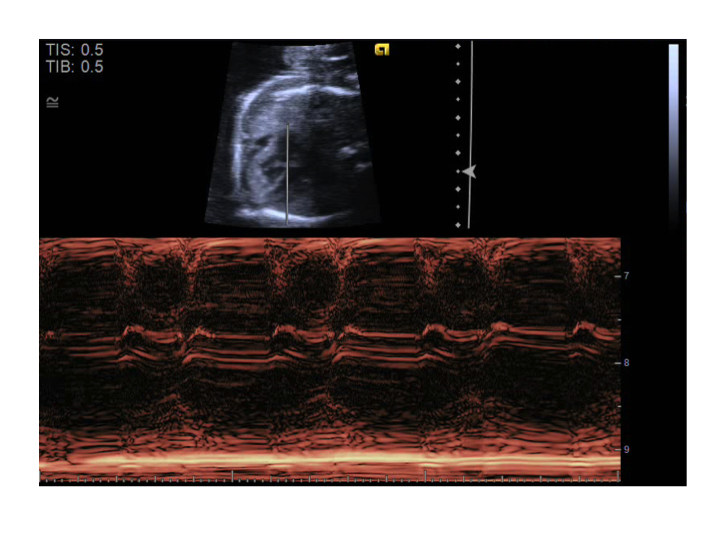 Premature Atrial Contractions (PACs) | Pediatric Echocardiography