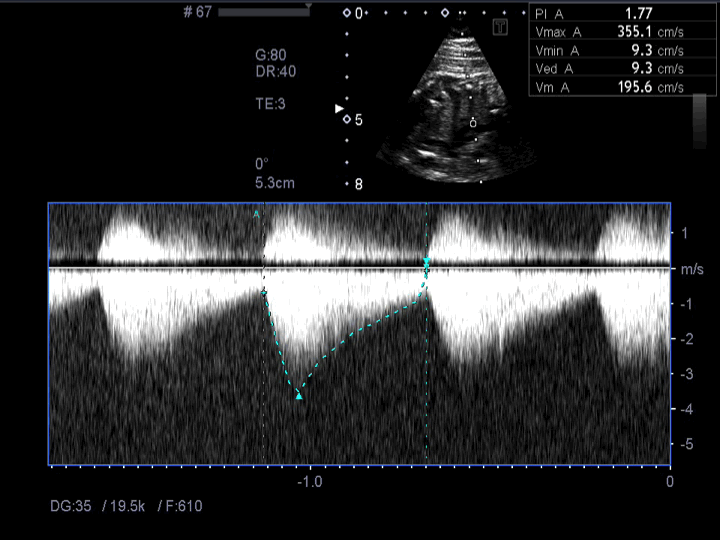 Premature Ductal Constriction Fetal Echo Clips | Pediatric Echocardiography