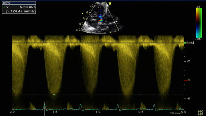 Parasternal long axis pulm valve | Pediatric Echocardiography