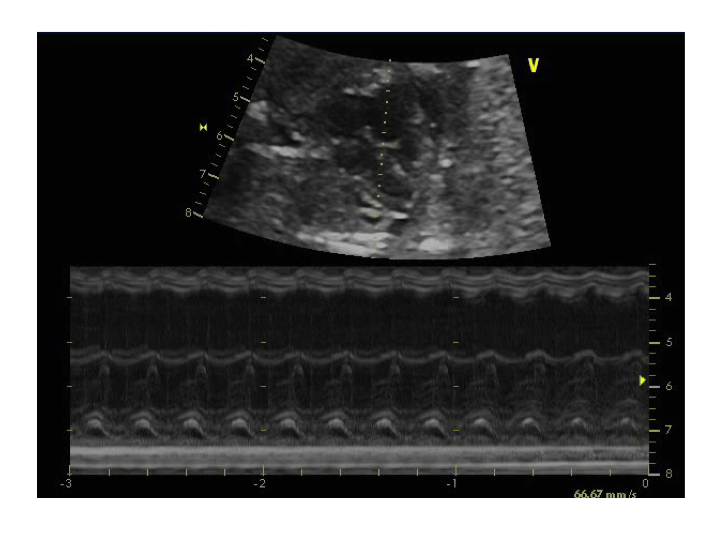 Supraventricular Tachycardia | Pediatric Echocardiography