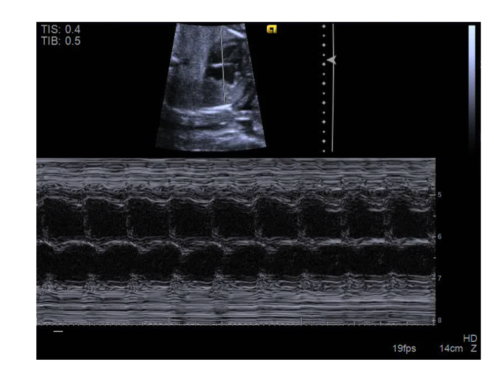 Supraventricular Tachycardia | Pediatric Echocardiography