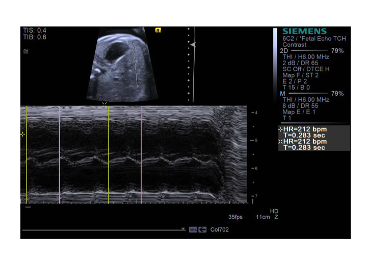Supraventricular Tachycardia | Pediatric Echocardiography