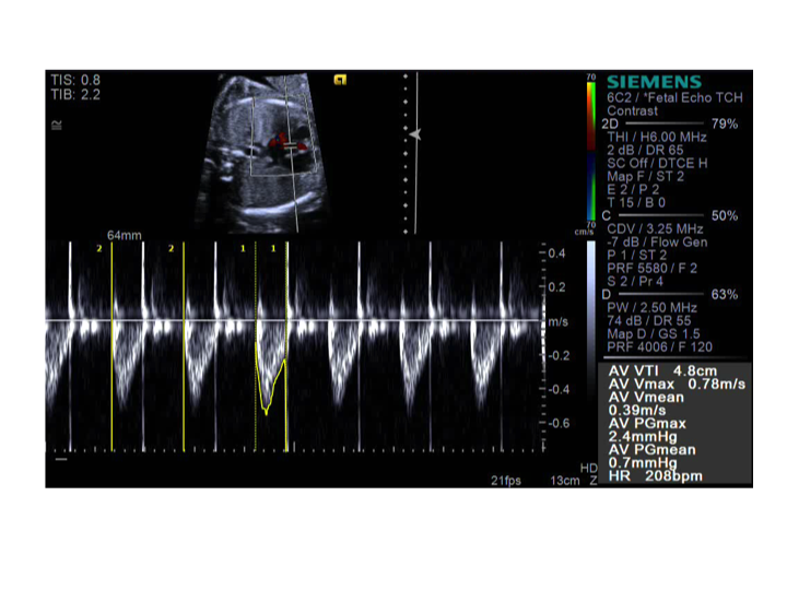 Supraventricular Tachycardia | Pediatric Echocardiography