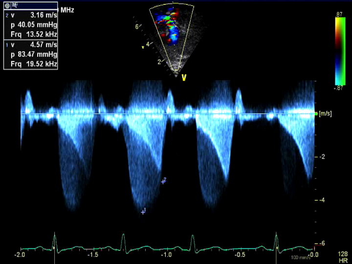 Apical 5 chamber | Pediatric Echocardiography