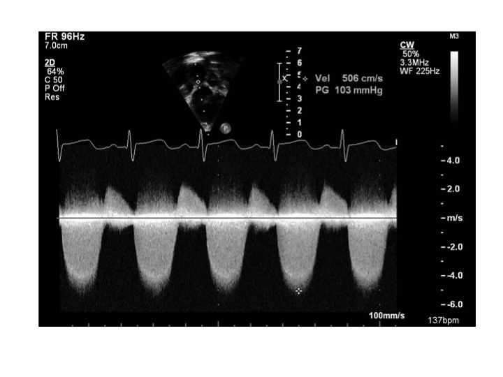 Apical 5 chamber anterior tilt pulmonary valve | Pediatric Echocardiography