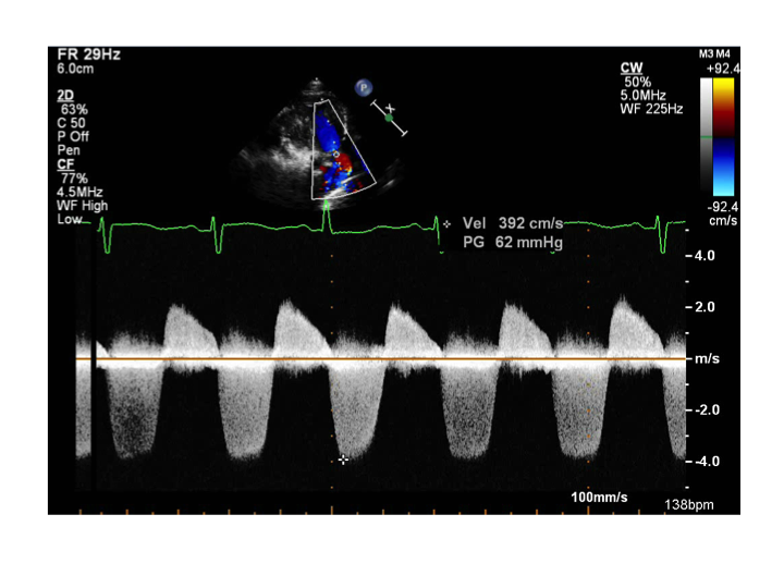 Parasternal long axis pulmonary valve | Pediatric Echocardiography