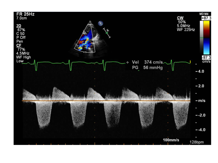 Parasternal short axis RVOT PV PAs | Pediatric Echocardiography