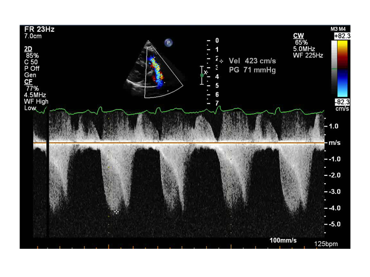 Parasternal long axis pulm valve | Pediatric Echocardiography