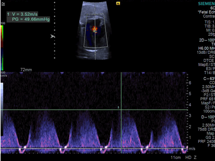 Premature Ductal Constriction Fetal Echo Clips | Pediatric Echocardiography