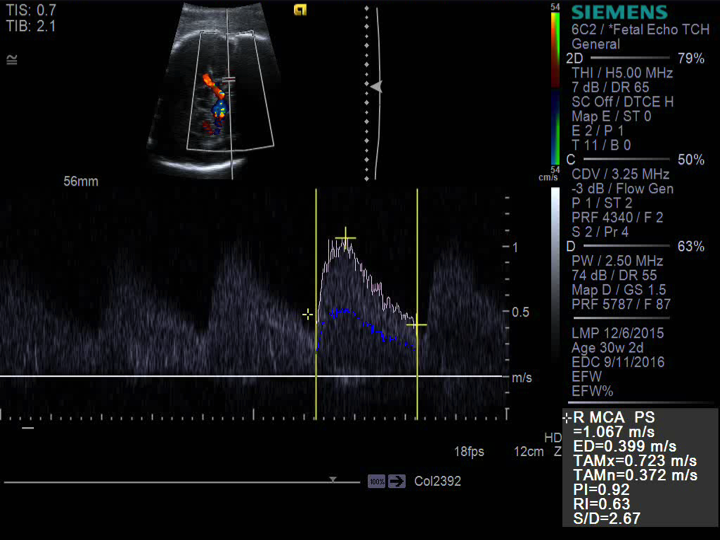 Vein of Galen Malformation Fetal Echo Clips | Pediatric Echocardiography