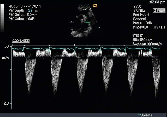 SSN Aortic Arch Pediatric Echocardiography